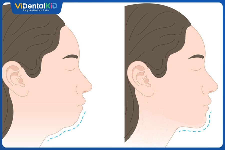 Mewing Là Gì? Lợi Ích, Đối Tượng Và Các Bước Thực Hiện